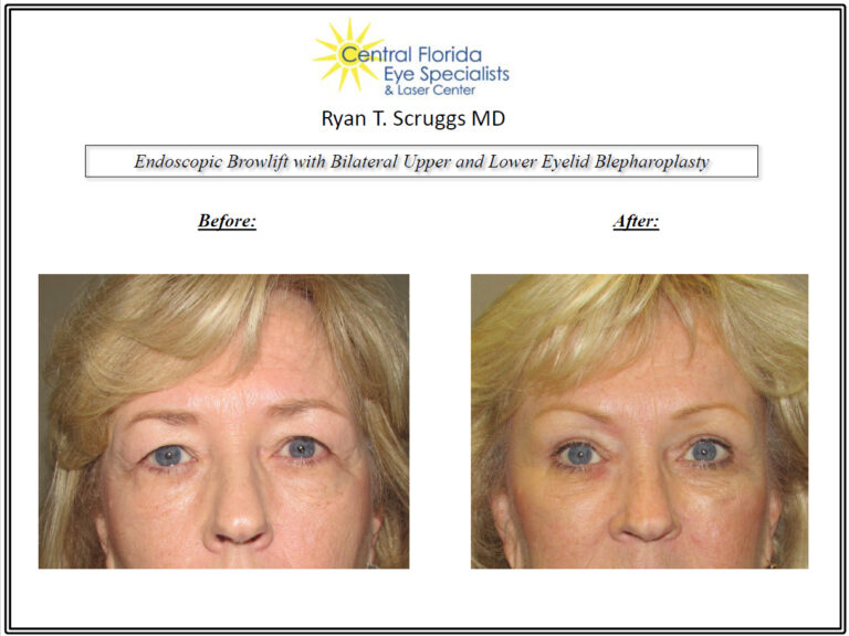 Before and After Gallery | Central Florida Eye Specialists