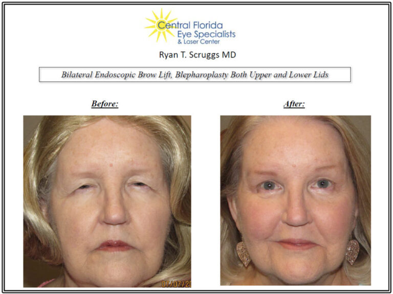 Before and After Gallery | Central Florida Eye Specialists