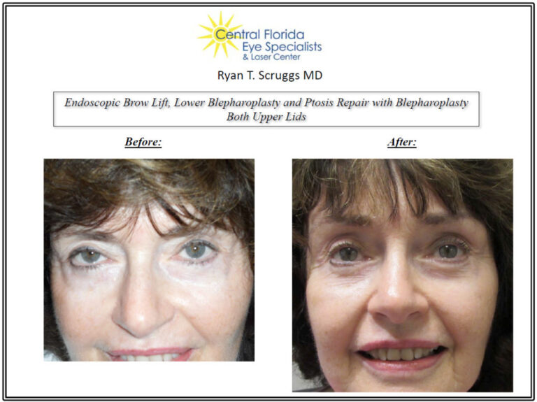 Before and After Gallery | Central Florida Eye Specialists