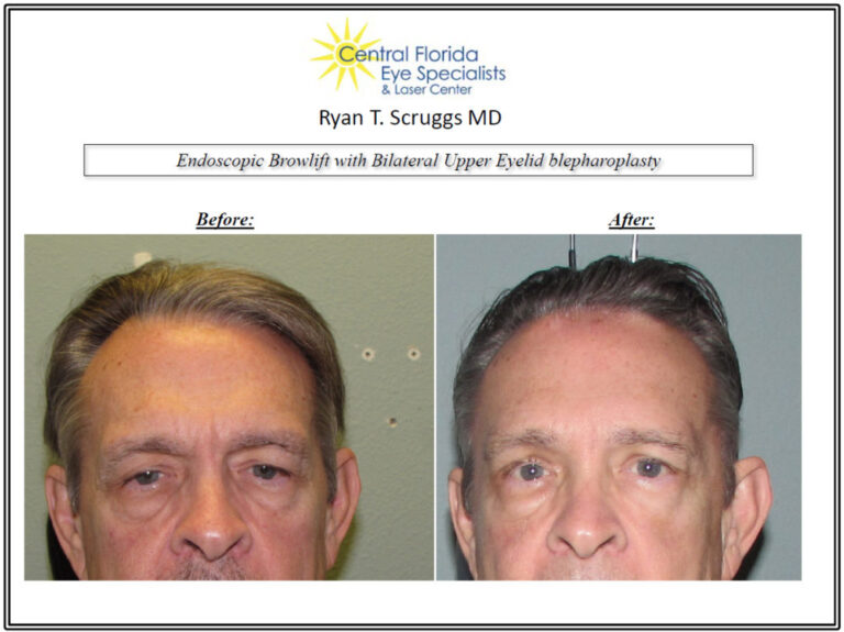 Before and After Gallery | Central Florida Eye Specialists